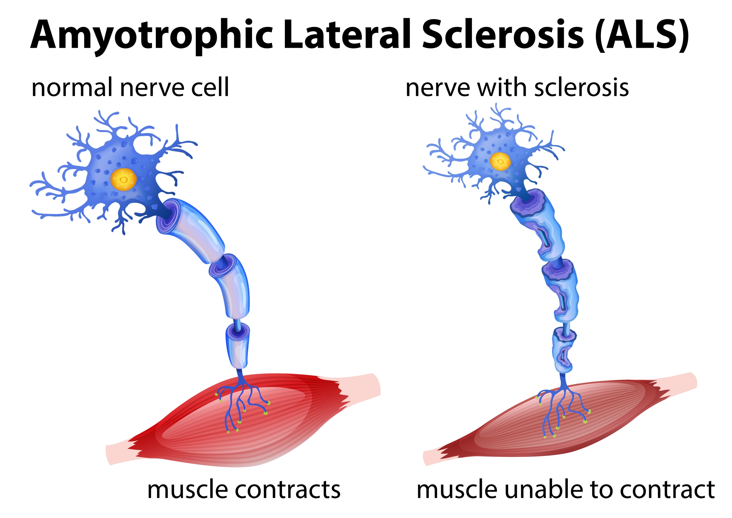 ALS and Neuroprotection: Can Stem Cells Protect Motor Neurons?